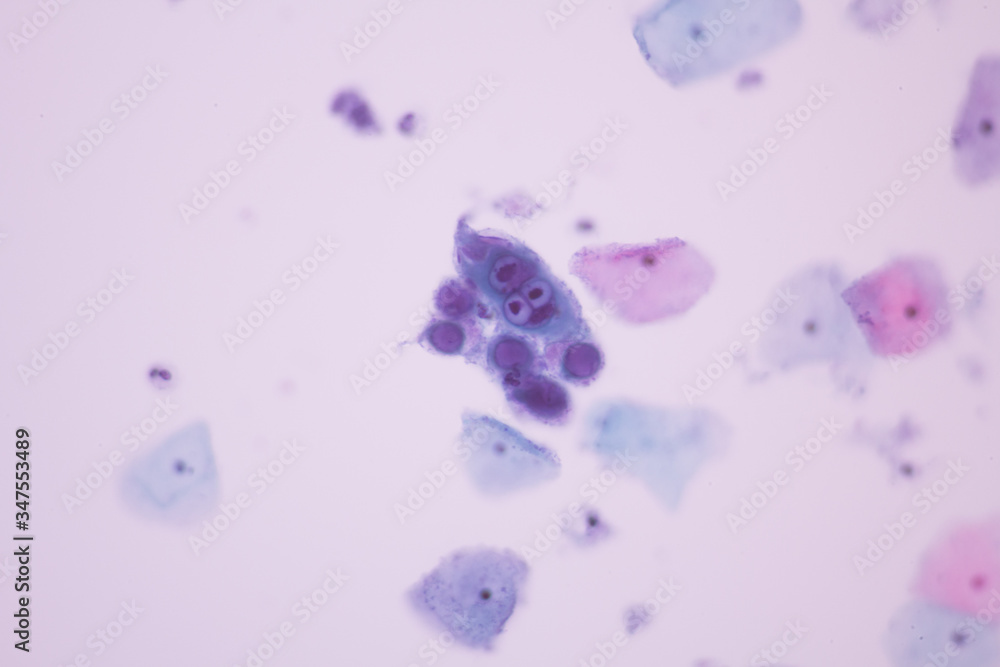 Image from microscopic of herpes simplex virus infection show ground ...