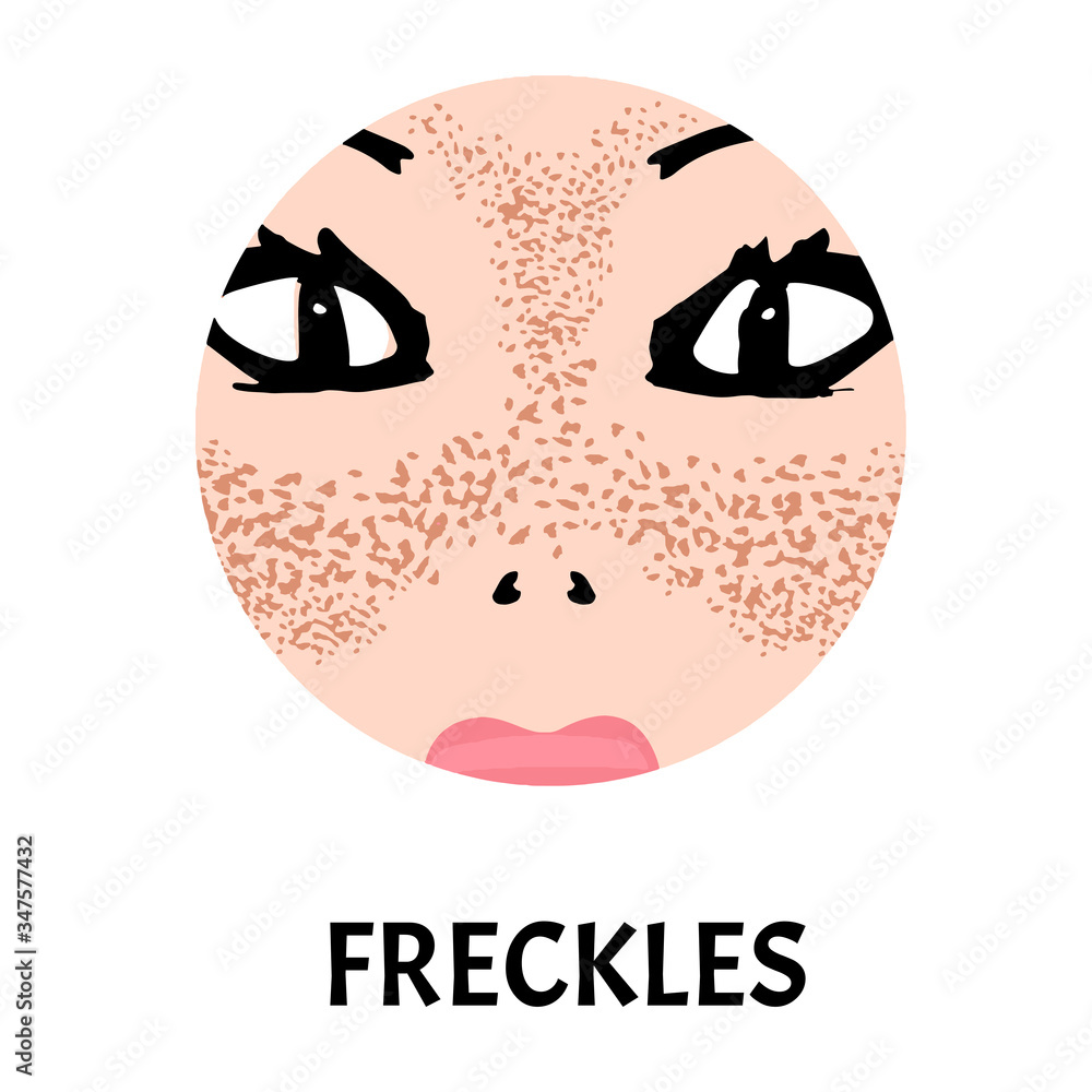 Freckles on the face. Pigmentation on the skin. A pigmented spot on the ...