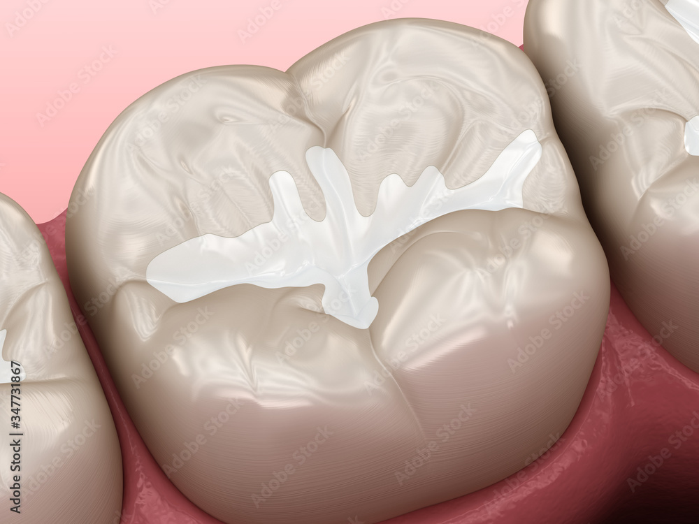 Molar Fissure dental fillings, Medically accurate 3D illustration of ...