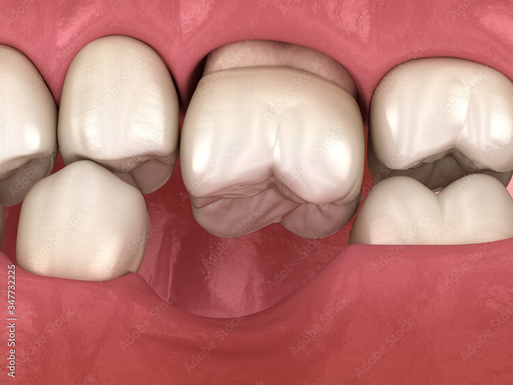 Teeth shift deformatiuon after losing molar tooth. 3D illustration of ...
