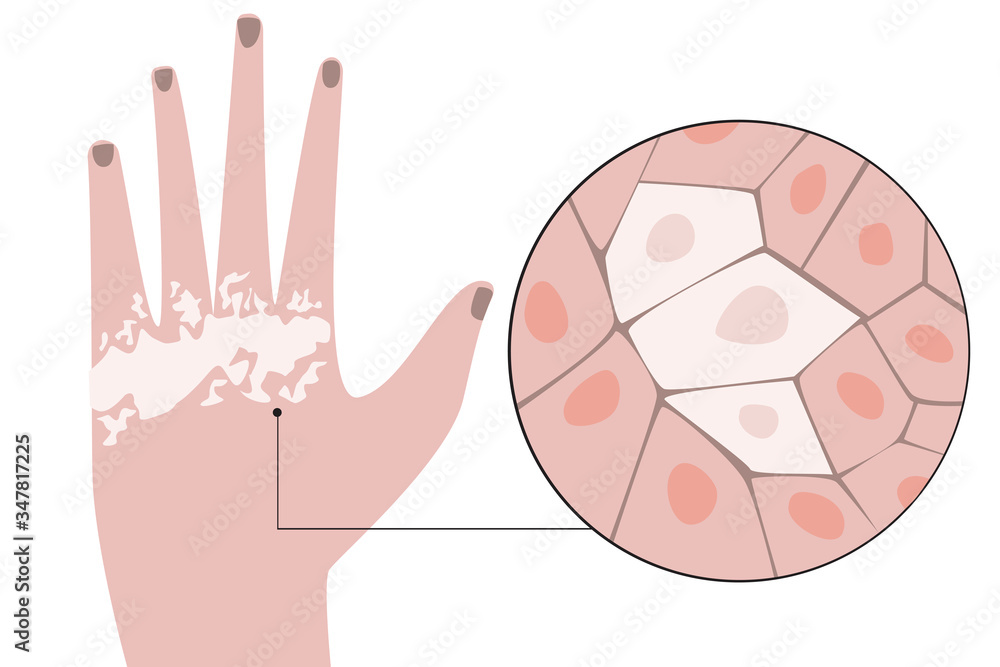 Hand with vitiligo and structure of skin cells as a concept for melanin ...