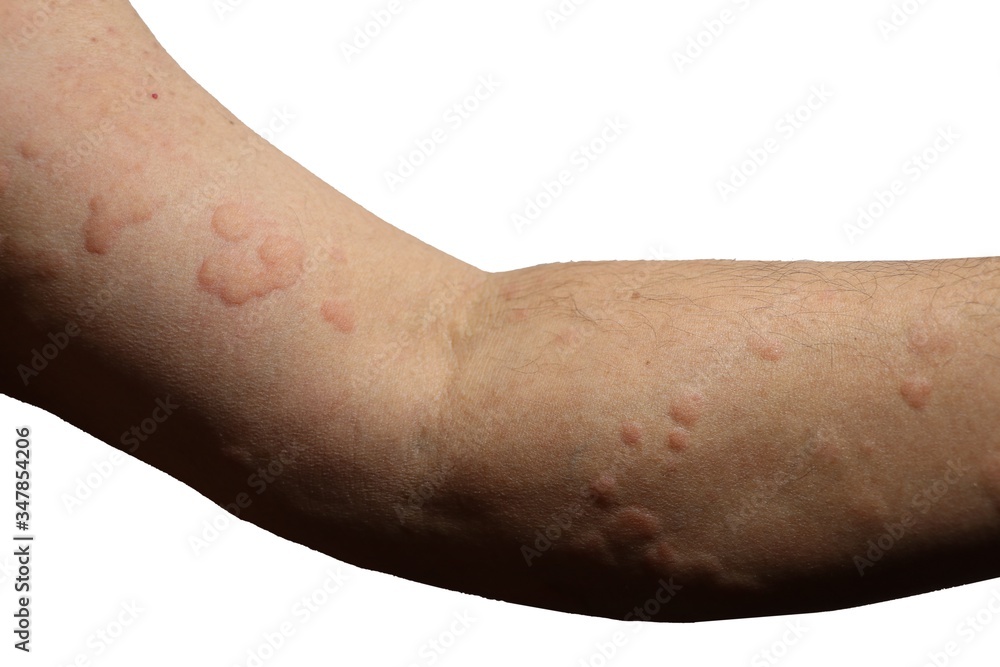 Urticaria on arm of a man over white isolated background. Stock Photo ...