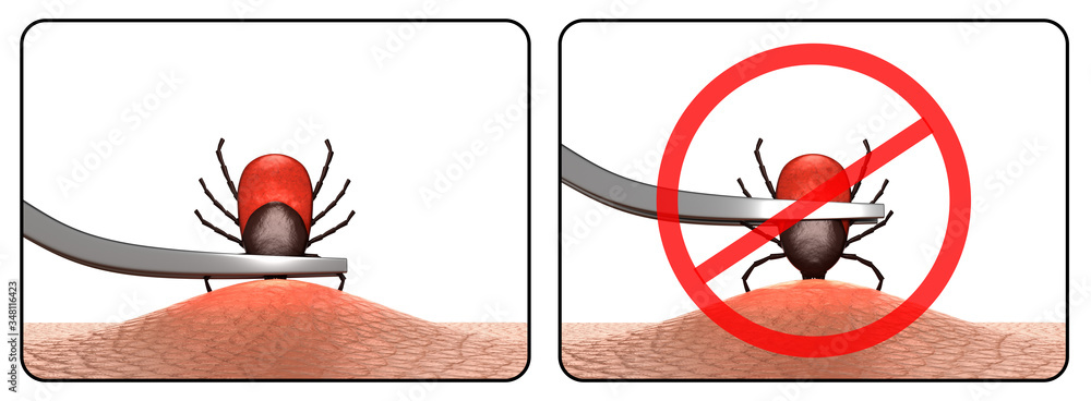 The correct way to remove a tick with forceps. 3D-rendering. Stock ...
