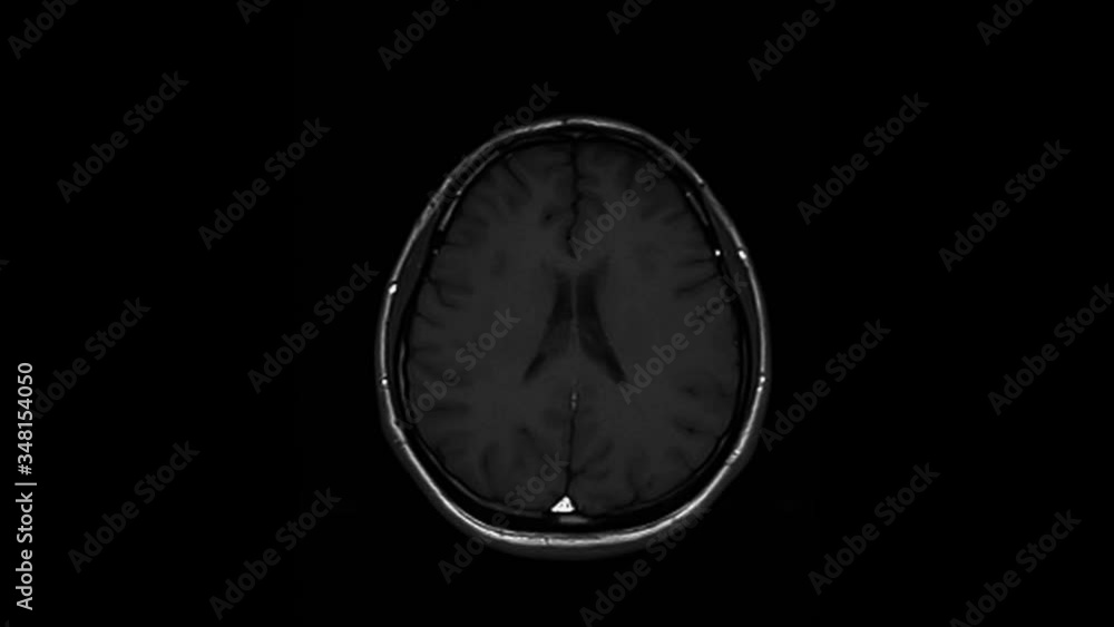 Series of animated scans from computerized tomography of brain vídeo do ...