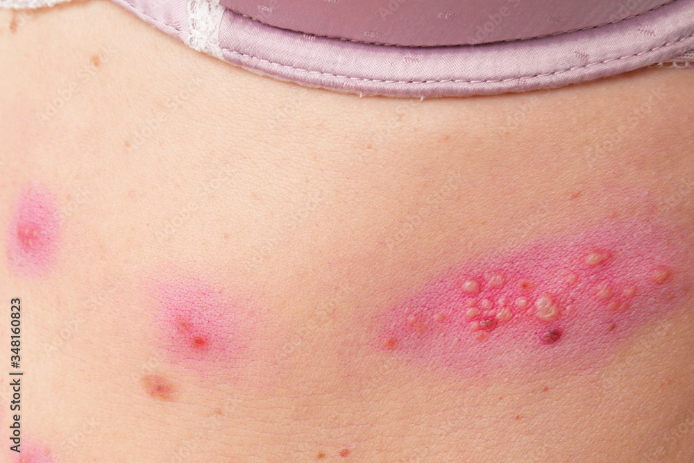 Foto de skin rash treatment on woman body. Shingles, Disease, Herpes ...