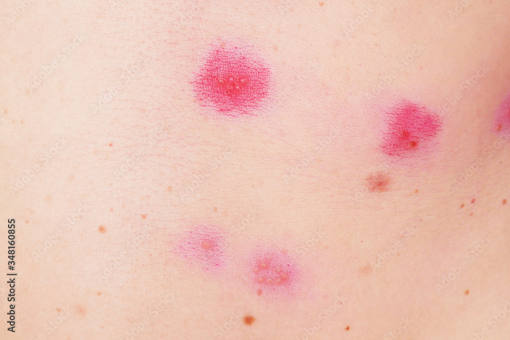 skin rash treatment on woman body. Shingles, Disease, Herpes zoster ...