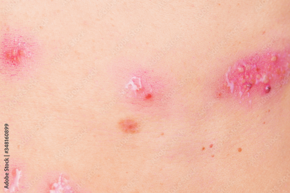 skin rash treatment on woman body. Shingles, Disease, Herpes zoster ...