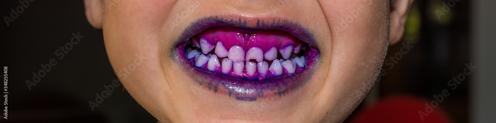 Dental plaque pill to indentefy teeth plaque. Blue colour shows plaque ...