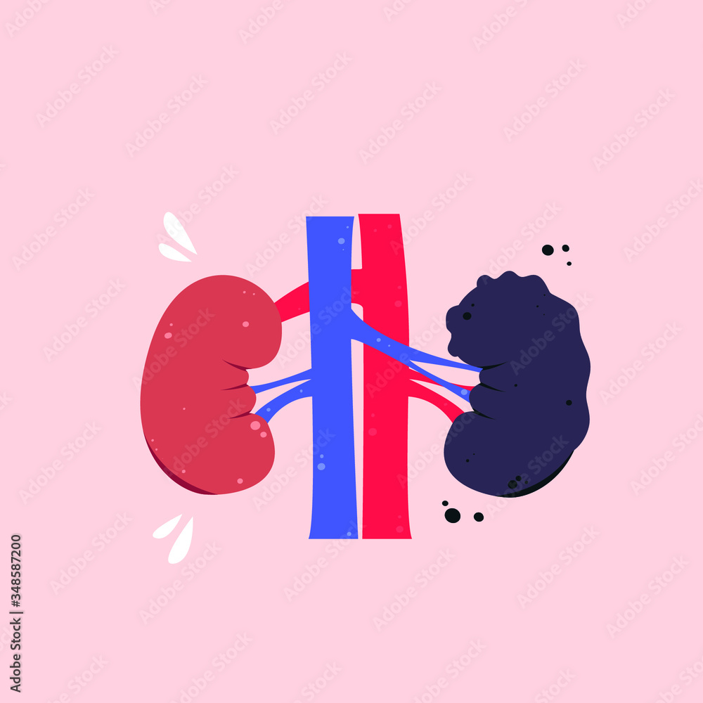 Healthy and unhealthy kidneys vector illustration. Kidney infection ...