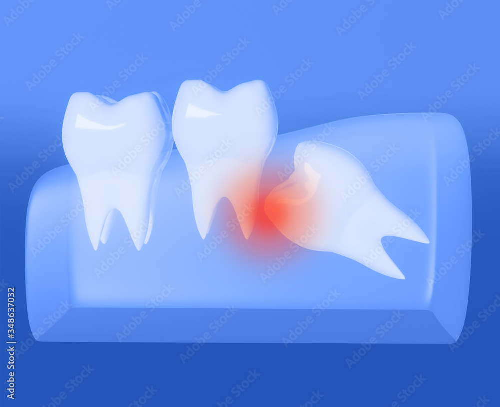 Wisdom tooth grows wrong, wisdom tooth problem, horizontal position of ...