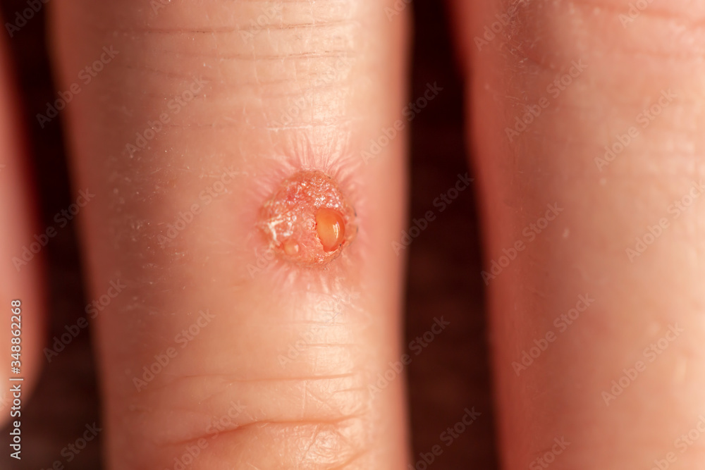 Open hand wound with leaking exudate while healing Stock Photo | Adobe ...