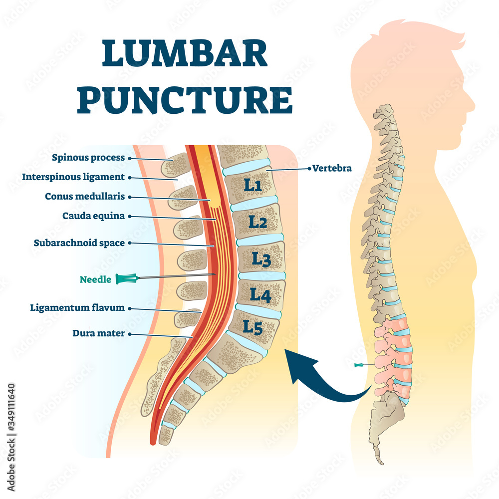 Lumbar puncture vector illustration. Labeled spine structure procedure ... Lumbar puncture vector illustration. Labeled spine structure procedure ...
