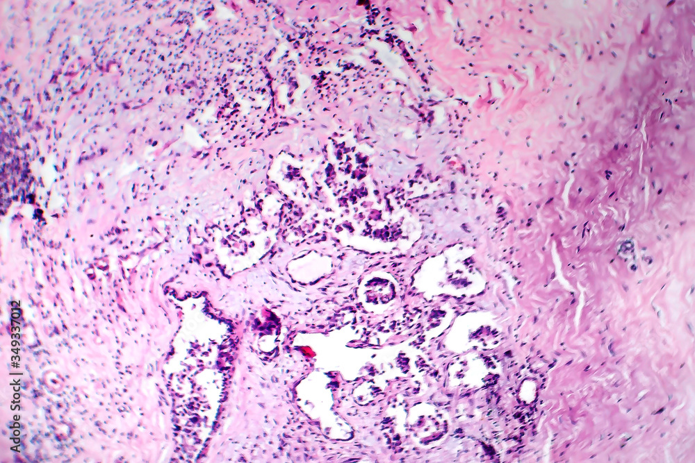 Breast fibroadenosis, light micrograph Stock Photo | Adobe Stock