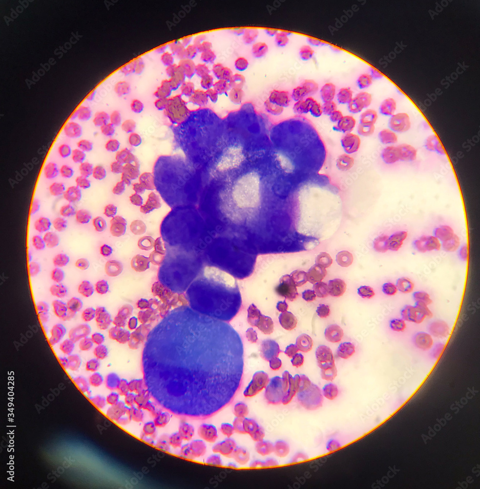 Atypical cells in body fluid smear. Stock Photo | Adobe Stock