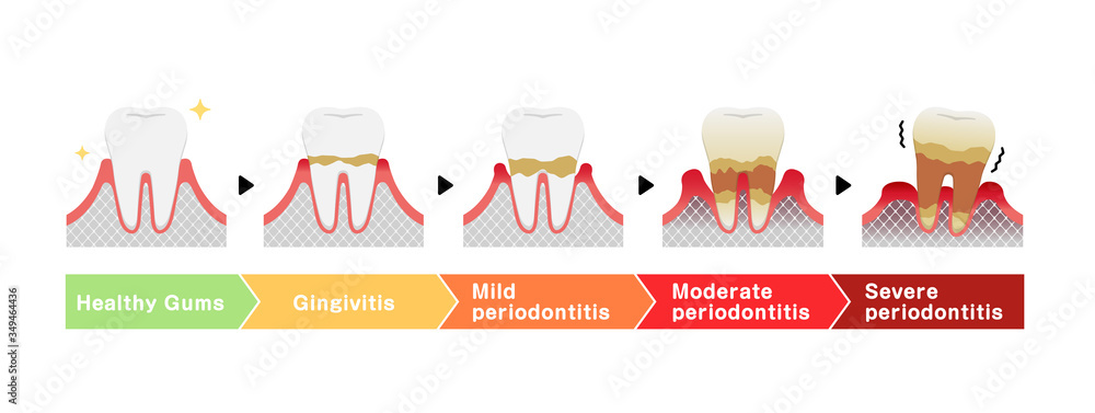 Poster The stages of periodontitis disease vector illustration – Wall ...
