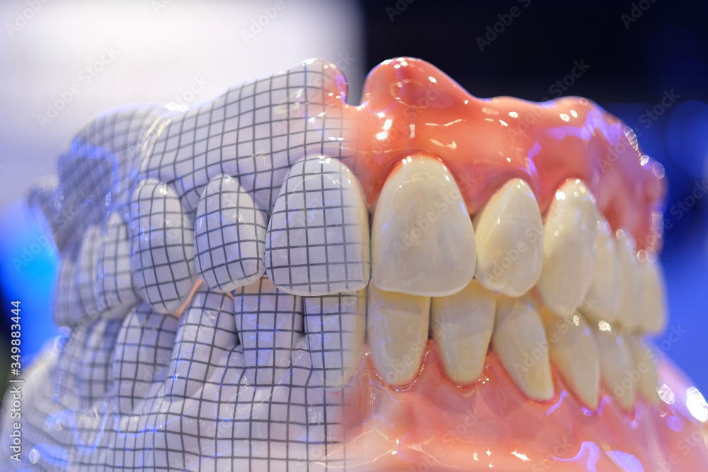 Samples of removable total prostheses of the upper and lower jaws Stock ...
