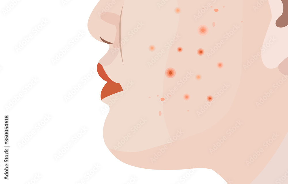 Pimple on woman face skin on white background vector Stock Vector ...