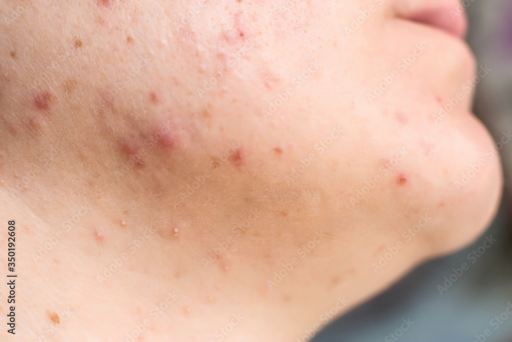 Red acne and a rash on a girl's face and neck, macro, hormone Stock ...