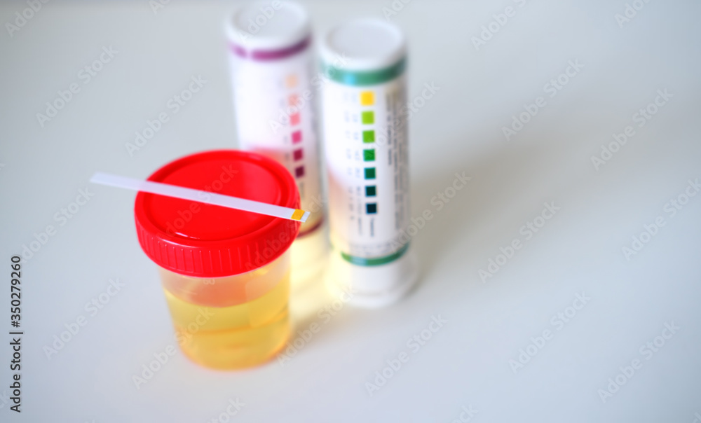 Medical exam, Urine test strip looking for infections and bacteria. Pee ...