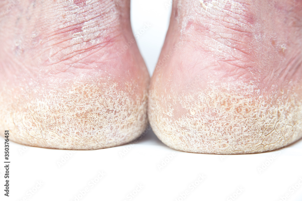 Close up acute psoriasis on male legs and heels is an autoimmune ...