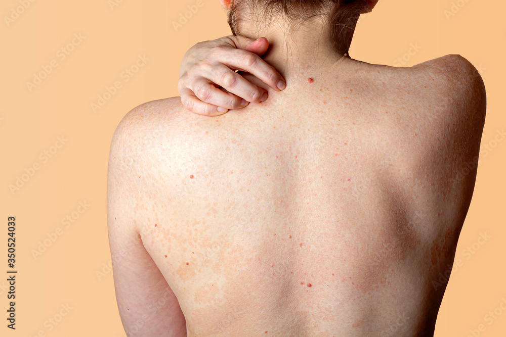 Allergic dermatitis on the skin of a woman's back. Skin disease ...
