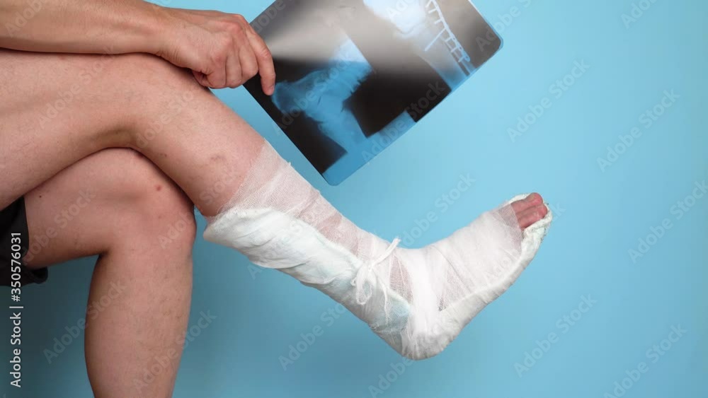 Legs of a man with a broken leg on a blue background. X-ray image of ...
