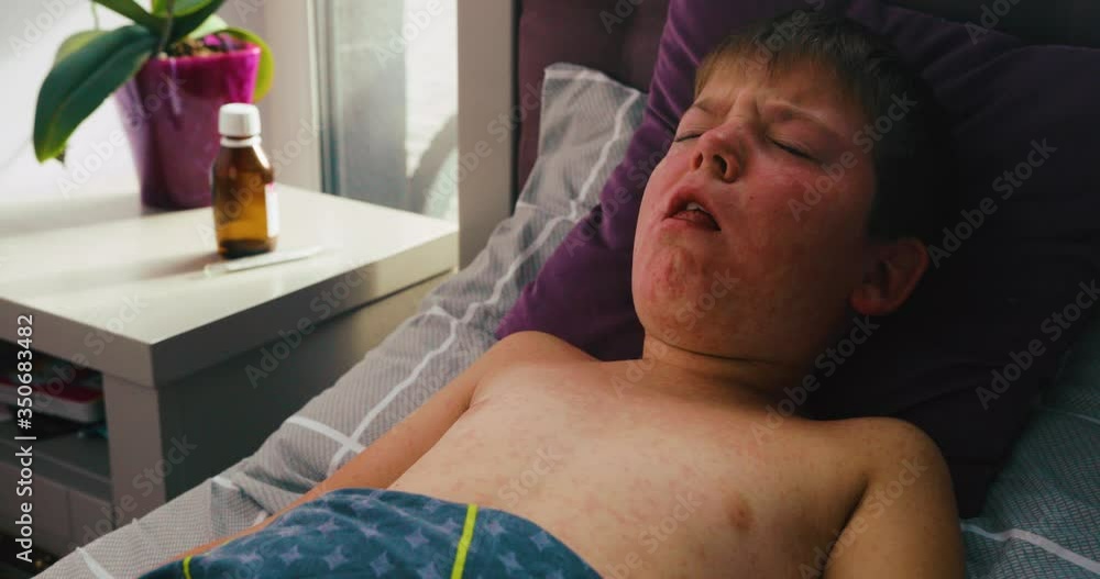 Viral disease. Measles rash. Child with viral infection measles lies in ...