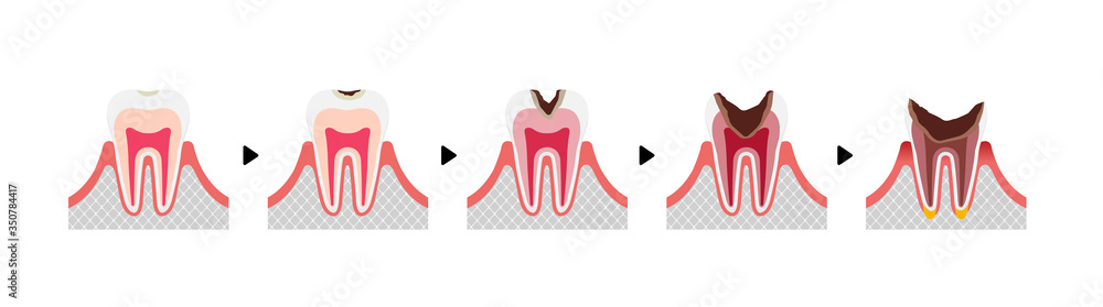 The stages of tooth decay / flat vector illustration (no text) Stock ...