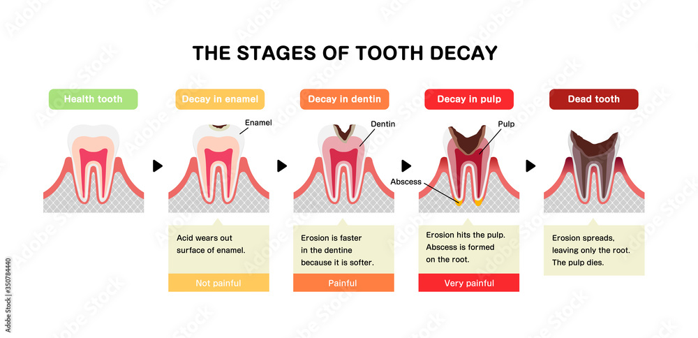 The stages of tooth decay / flat vector illustration Stock Vector ...