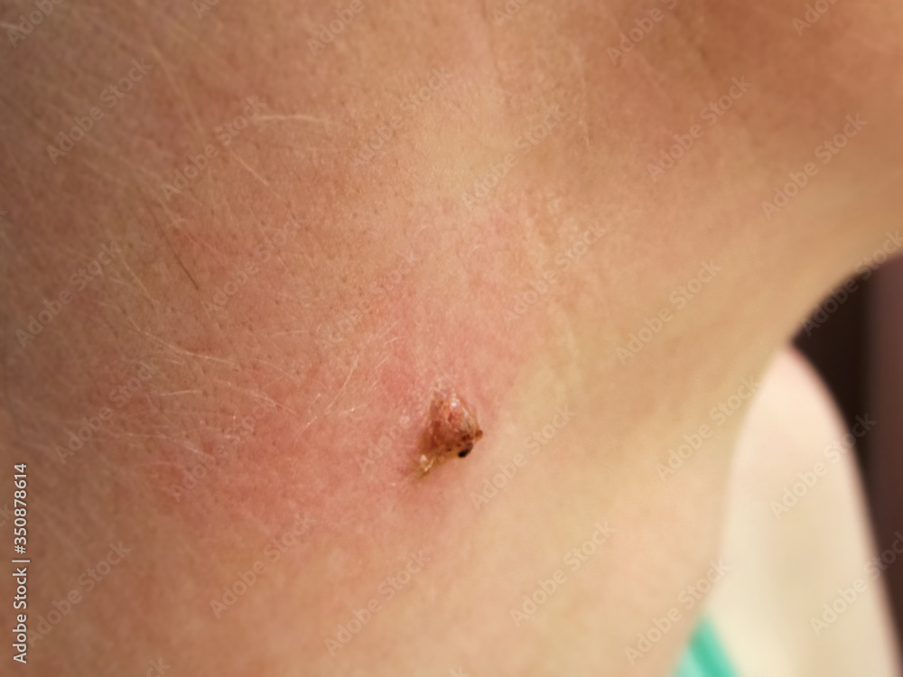 Large wart on the female neck, close-up. Cosmetic defect in human skin ...