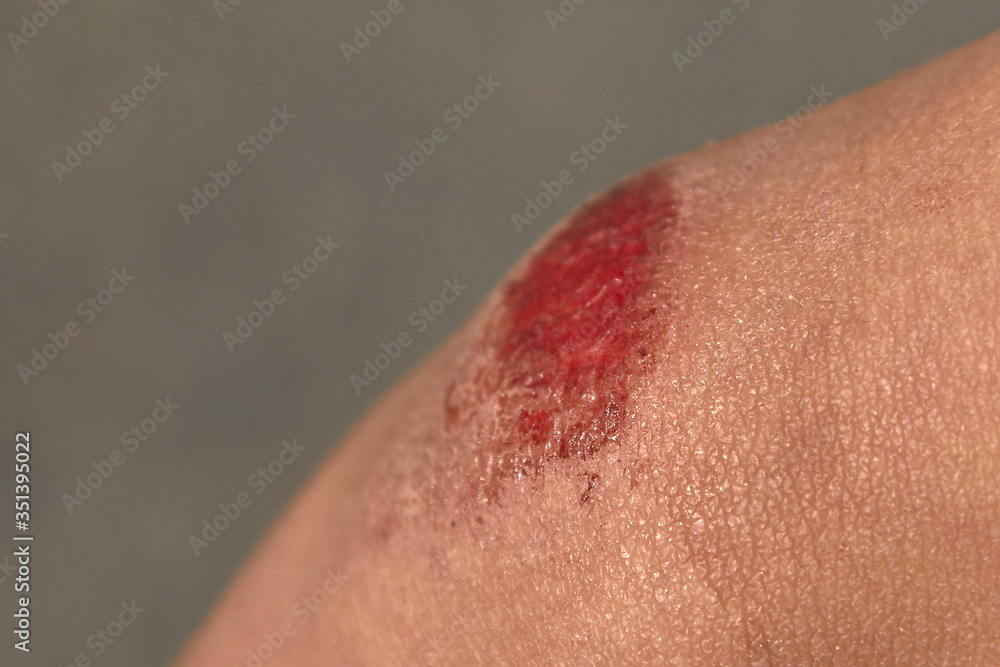 bruised wound on the knee, the boy fell and scratched his knee Stock ...