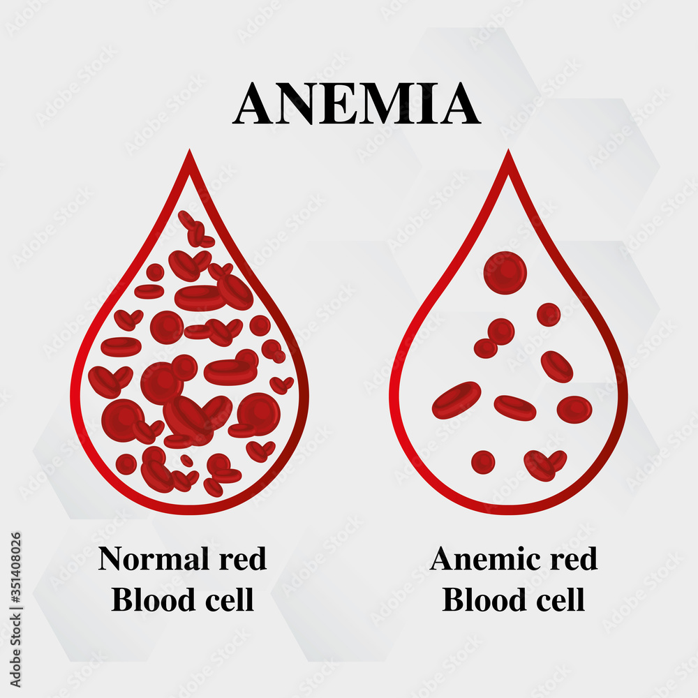 Plakát world hemophilia day red blood cell Iron deficiency anemia ...