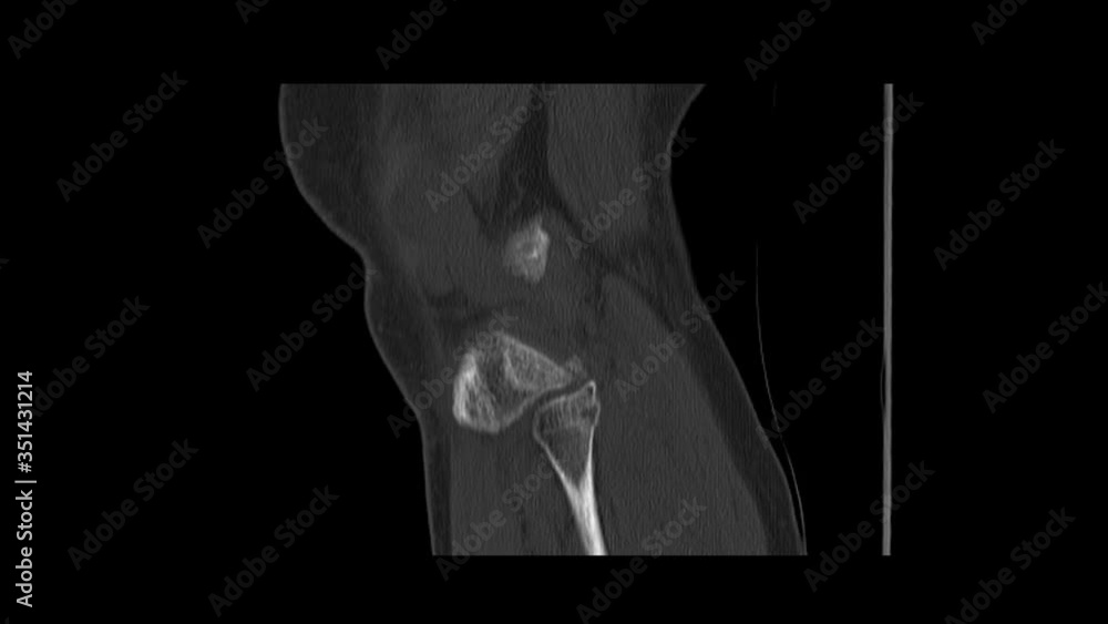 Video Stock CT Scan knee of the patient periarticular injuries fracture ...