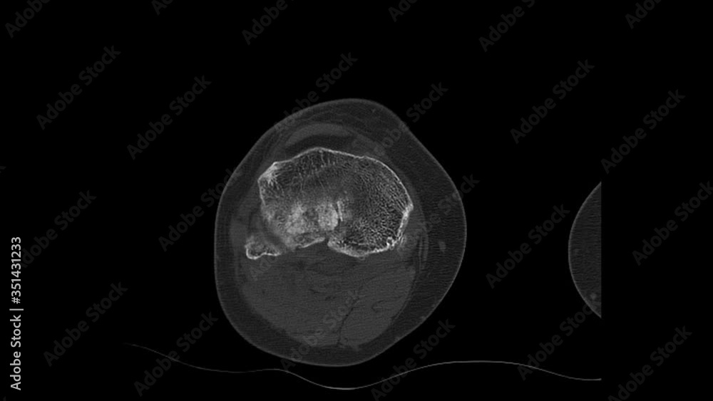 CT Scan knee of the patient periarticular injuries fracture of the ...