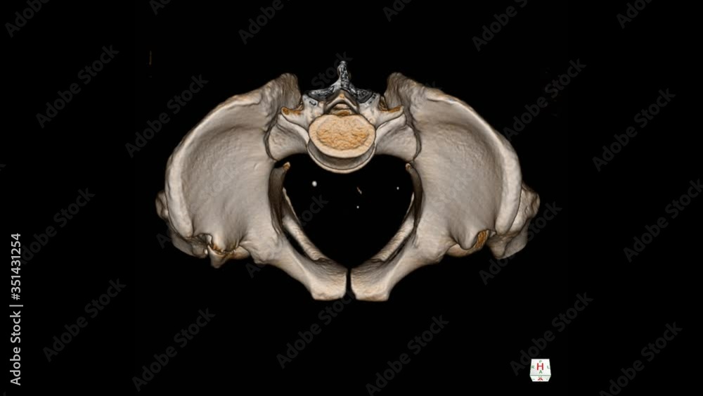 Video „CT Scan pelvis and Both hip joint space and articular surface ...