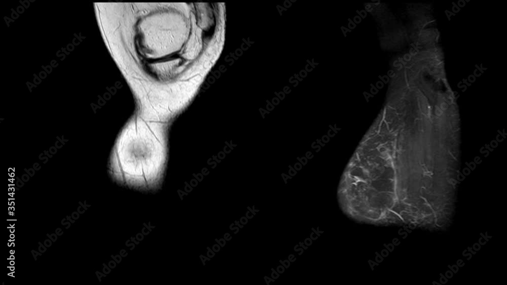 MRI (Magnetic resonance imaging) of Leg.A large, well-circumscribed ...