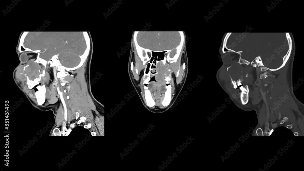 CT Scan neck finding A 3cm infiltrative mass at Right submandibular ...