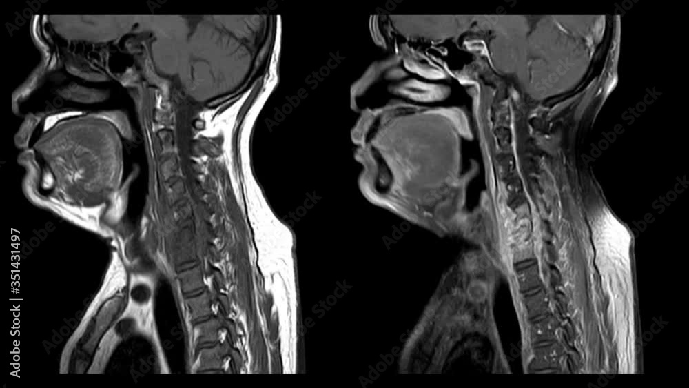 Magnetic resonance imaging(MRI) Cervical spine rule out Herniated disc ...