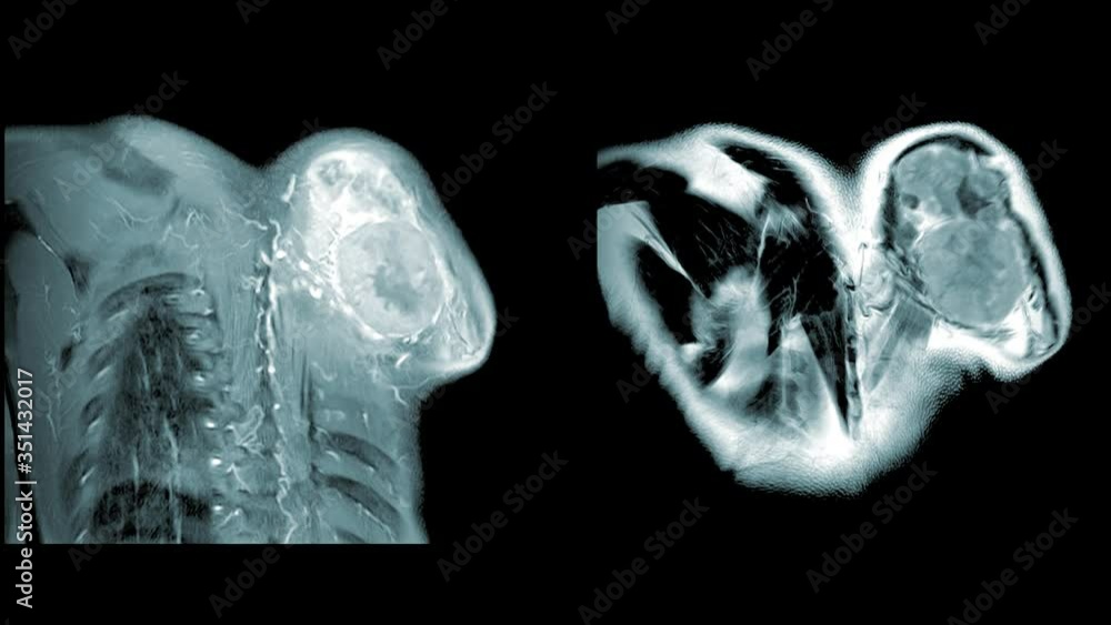 Magnetic resonance (MRI) of Shoulder Joint Impression:The mass Lt ...