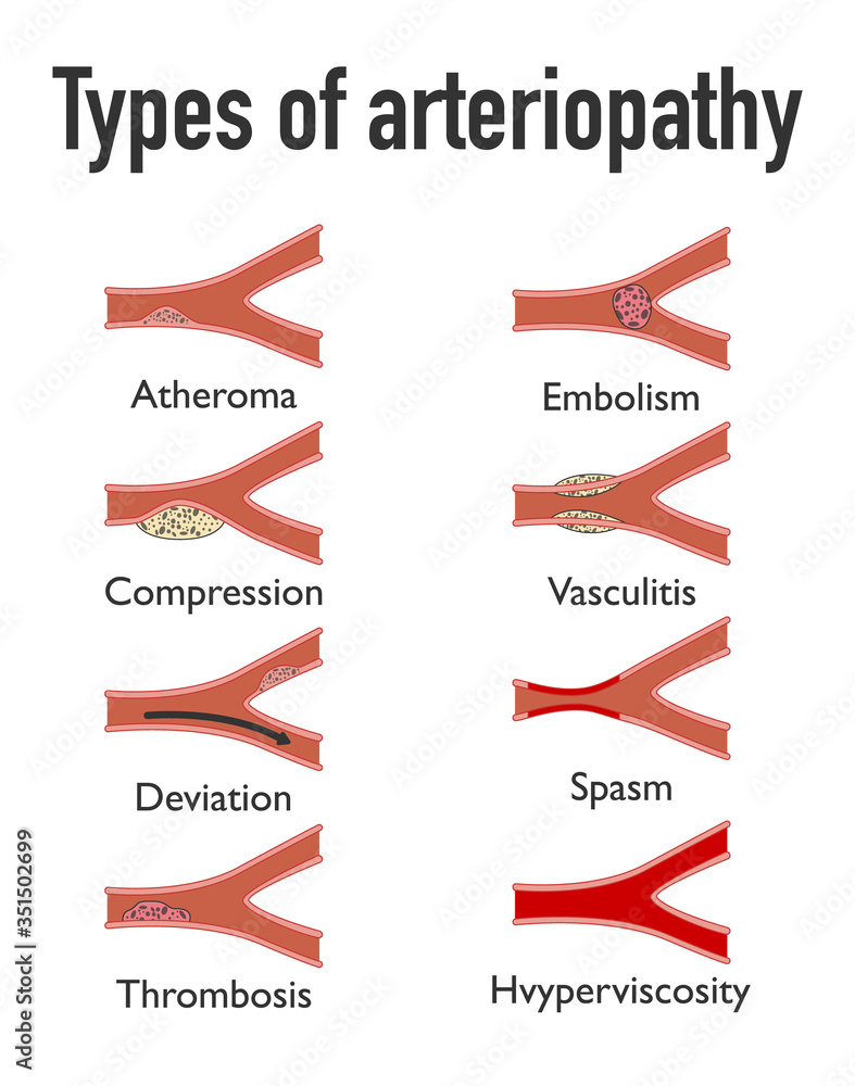 Types of arteriopathy, set of arteries atheroma, embolism, compression ...