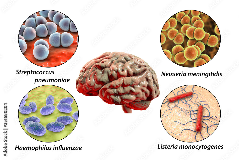 Etiology of bacterial meningitis Stock Illustration | Adobe Stock