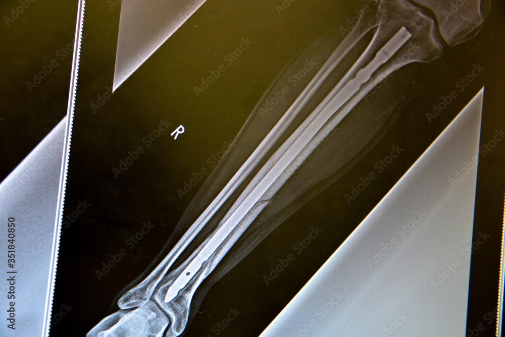 Broken right leg tibia surgery procedure. Metallic rod inserted inside ...