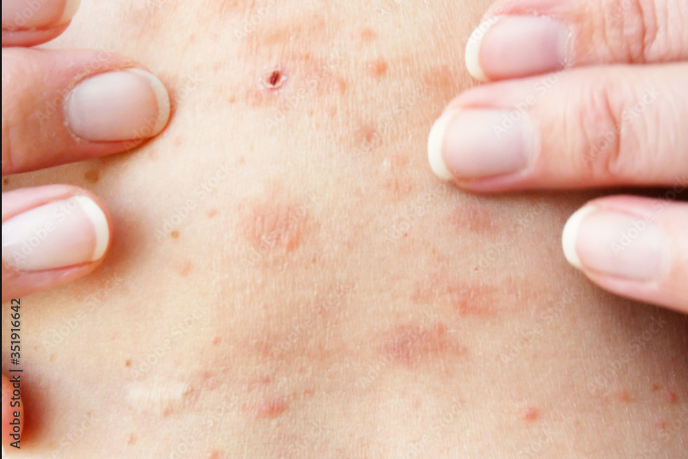 Fotografia do Stock: skin rash treatment on woman body. Shingles ...