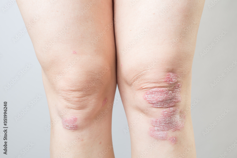 Acute Psoriasis On The Knees Is An Autoimmune Incurable Dermatological Skin Disease Large Red