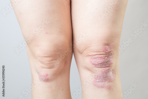 Acute psoriasis on the knees is an autoimmune incurable dermatological ...
