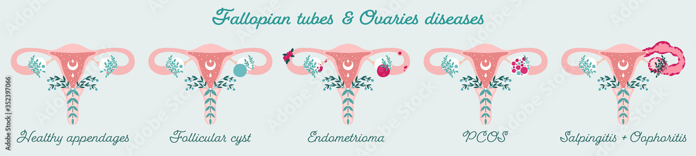 Women health - Fallopian tubes and Ovaries disorders - PCOS ...