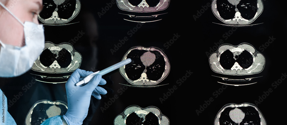 Coronavirus covid19, computed tomography of the lungs with pneumonia ...