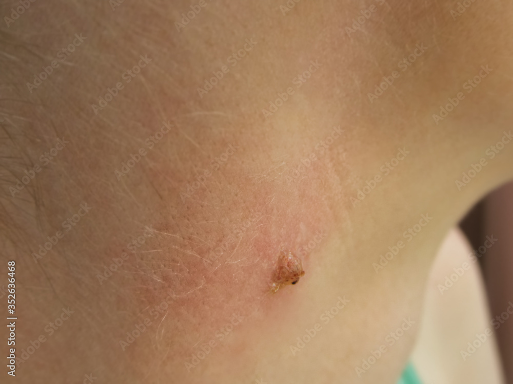 Brown wart-papilloma on the neck of a girl, close-up. Medical and ...