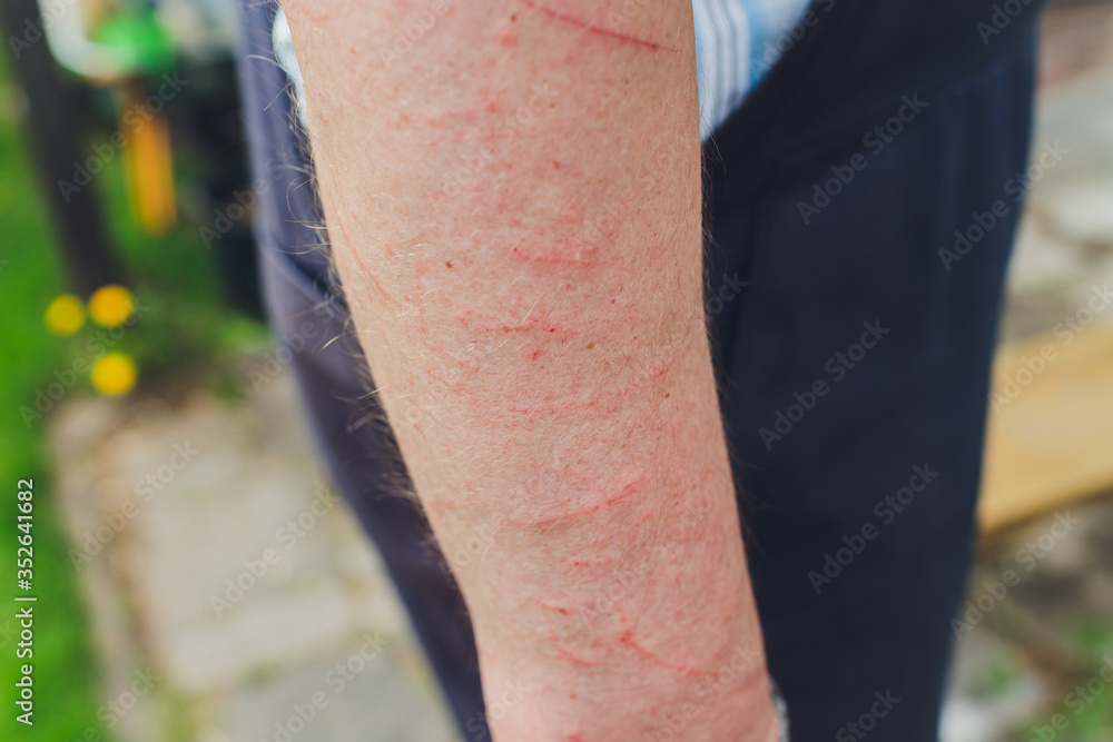 Skin allergy diseases problem, Poison tree contact dermatitis rash by ...