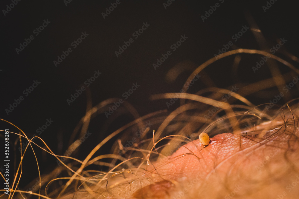 Fotografia do Stock: Macro photo of a tick stuck in the skin of a male ...